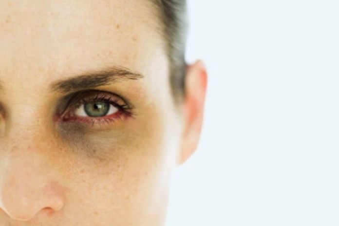 Dark Circles: Causes And Remedies To Eliminate Them