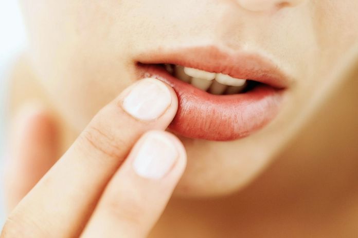 Dry Lips: How To Prevent And Treat This Problem?