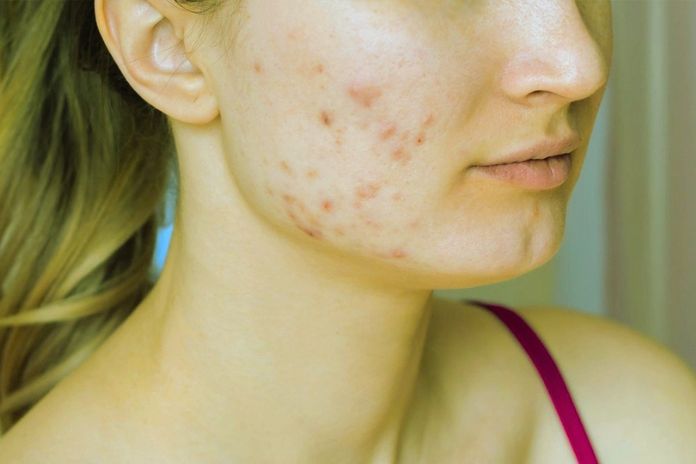 How To Quickly Remove A Pimple On The Face?